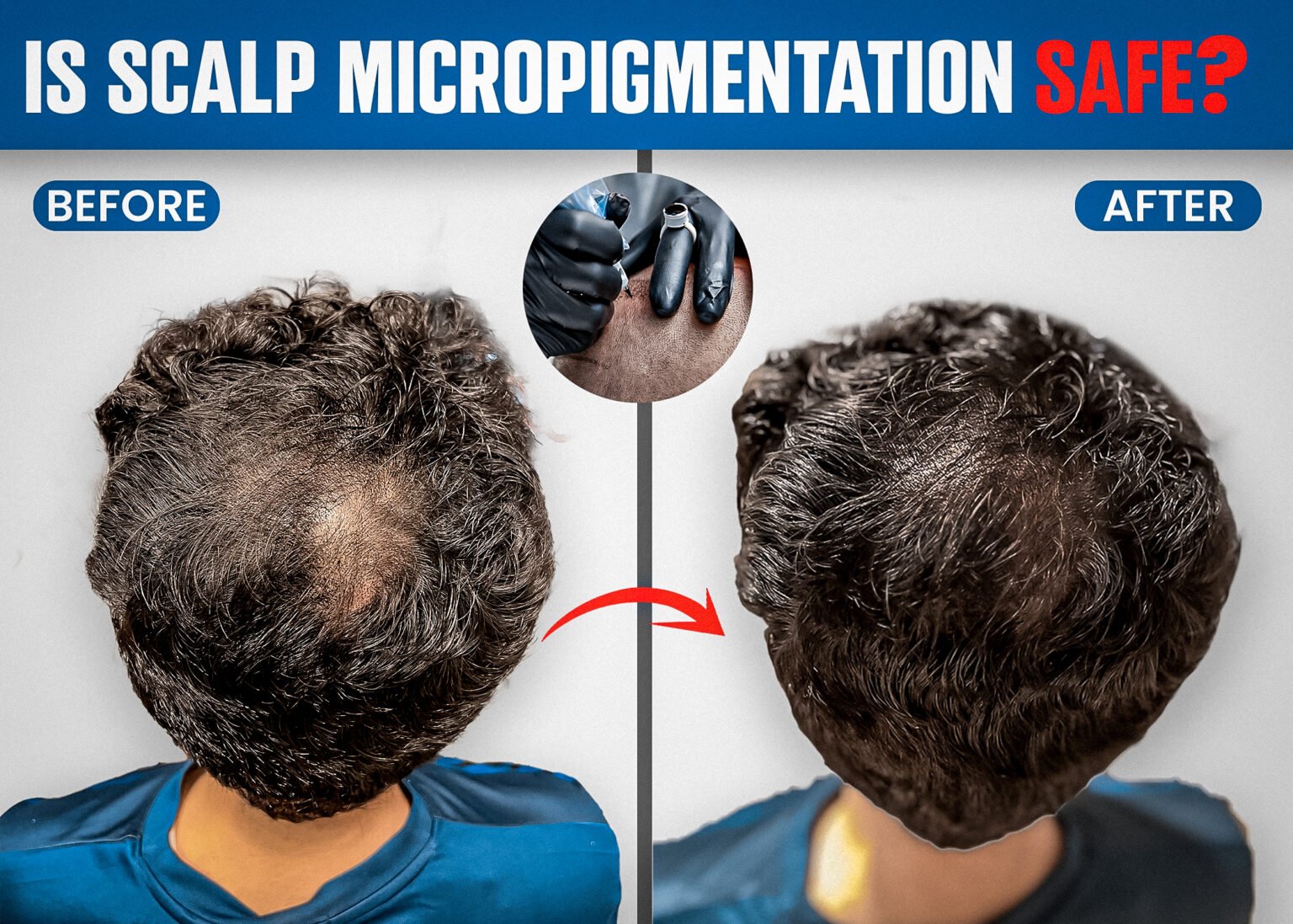 Can Scalp Micropigmentation Be Removed? Understanding the Reversal ...