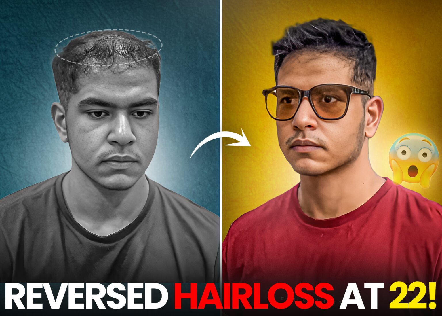 Balding at Twenty-Two? The Surprising Science Behind Early Hair Loss ...